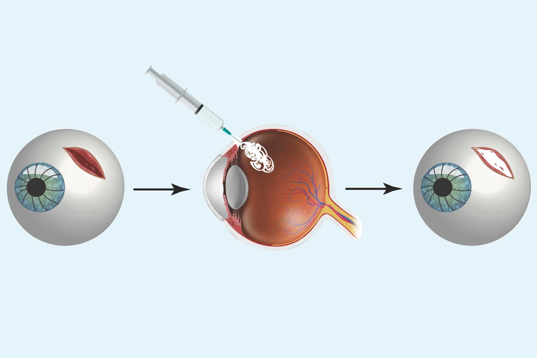A new portable gel that could save an injured eye - USC Today